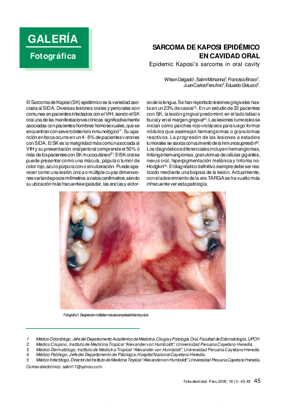 (PDF) Sarcoma de Kaposi Epidémico en Cavidad Oral