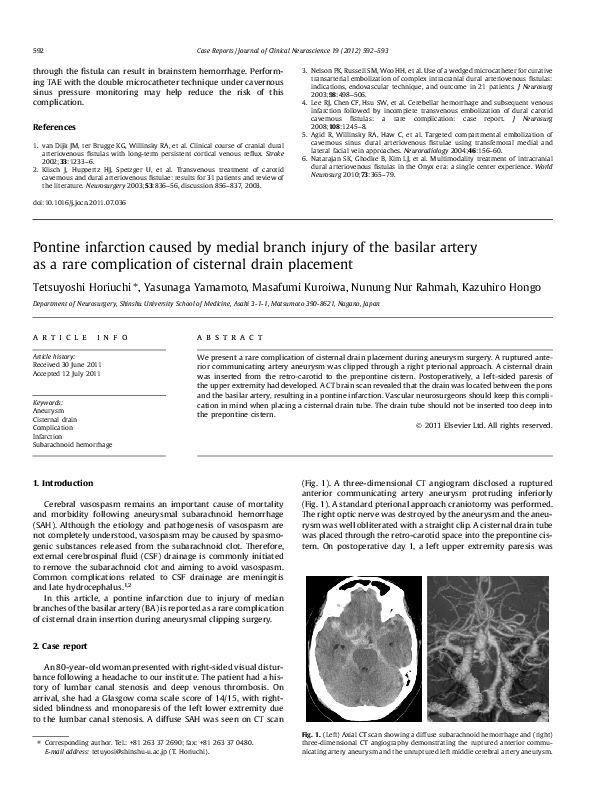 (PDF) Pontine infarction caused by medial branch injury of the basilar ...