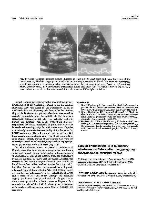 (PDF) Balloon embolization of a pulmonary arteriovenous fistula after ...