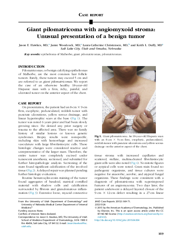(PDF) Giant pilomatricoma with angiomyxoid stroma: Unusual presentation ...