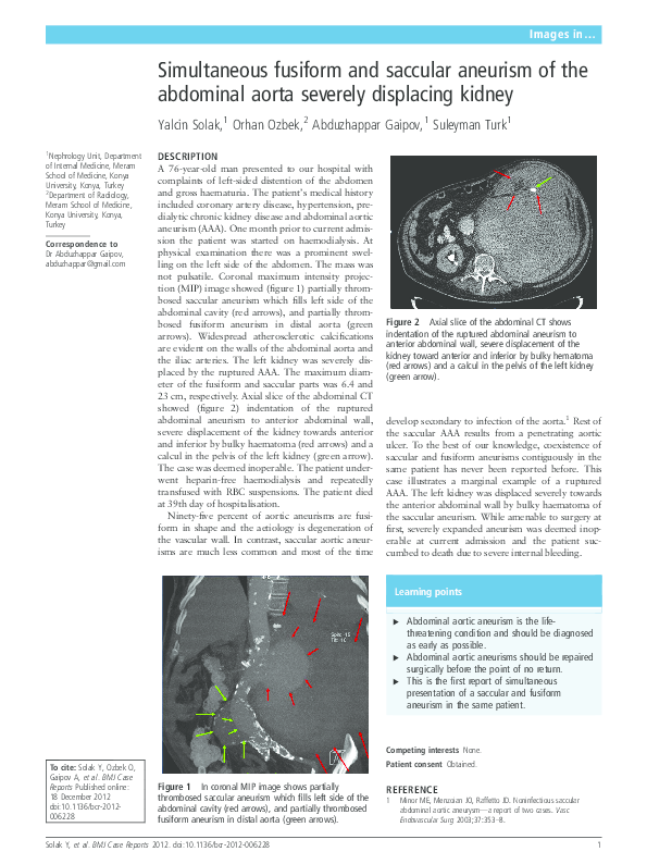 (PDF) Simultaneous fusiform and saccular aneurism of the abdominal ...