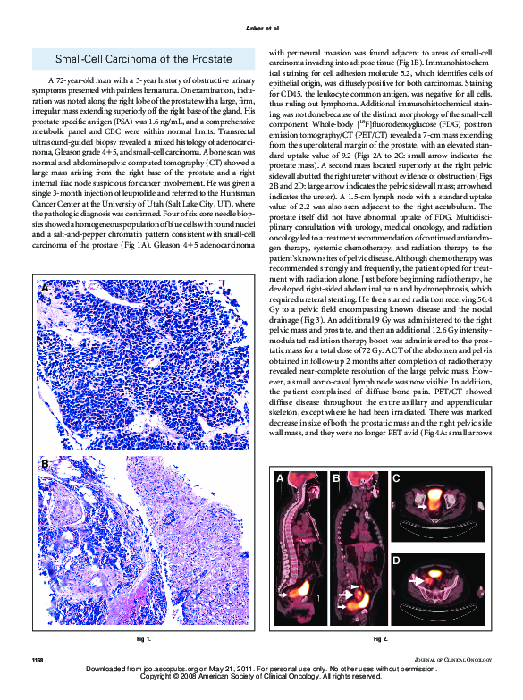 (PDF) Small cell carcinoma of the prostate