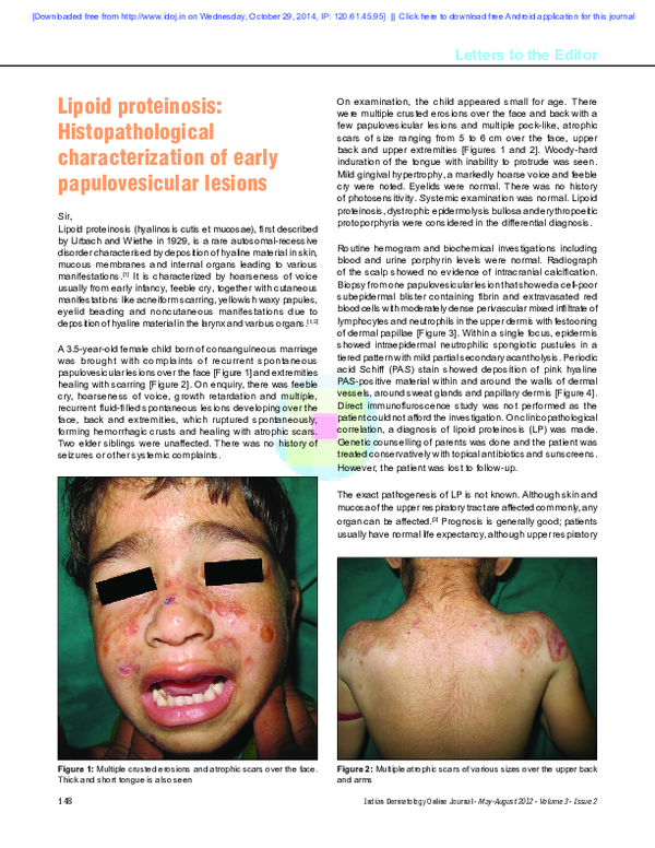 (PDF) Lipoid proteinosis: Histopathological characterization of early ...