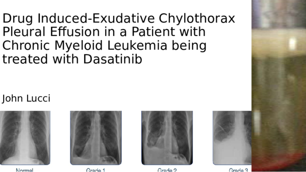 (PPT) Drug Induced-Exudative Chylothorax Pleural Effusion in a Patient with Chronic Myeloid ...