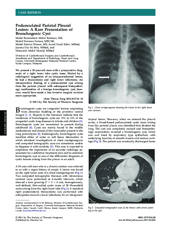 (PDF) Pedunculated Parietal Pleural Lesion: A Rare Presentation of ...