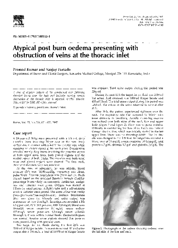 (PDF) Atypical post burn oedema presenting with obstruction of veins at ...