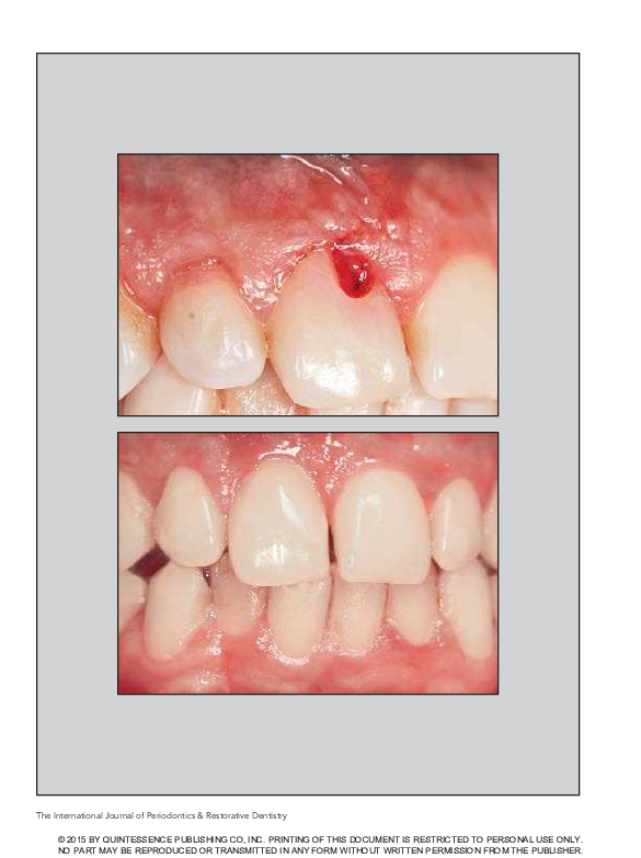 (PDF) Invasive Cervical Resorption: A Case Series with 3-Year Follow-Up