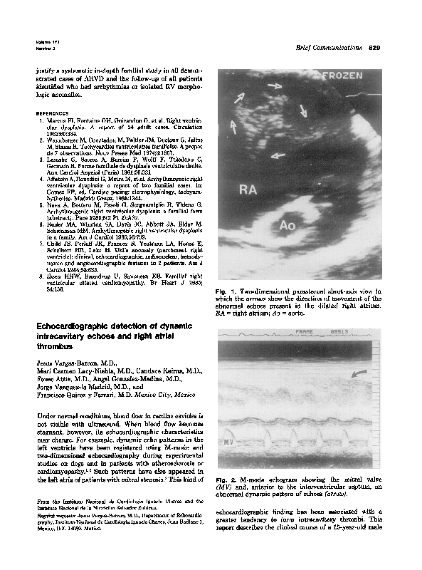 (PDF) Echocardiographic detection of dynamic intracavitary echoes and right atrial thrombus ...