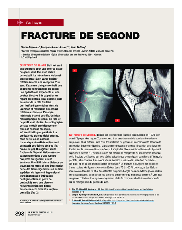 (PDF) [Segond fracture]