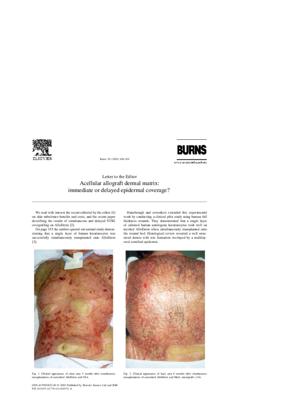 (PDF) Acellular allograft dermal matrix: immediate or delayed epidermal ...