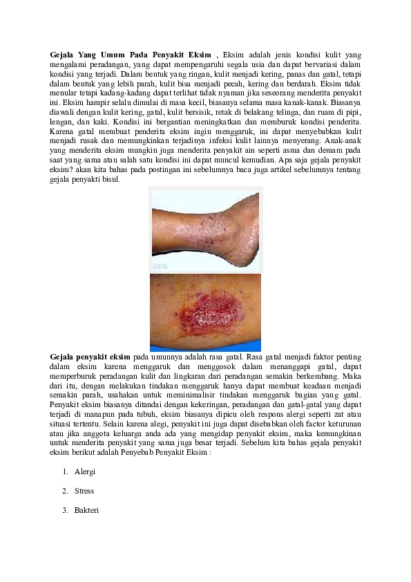 (DOC) Gejala Yang Umum Pada Penyakit Eksim