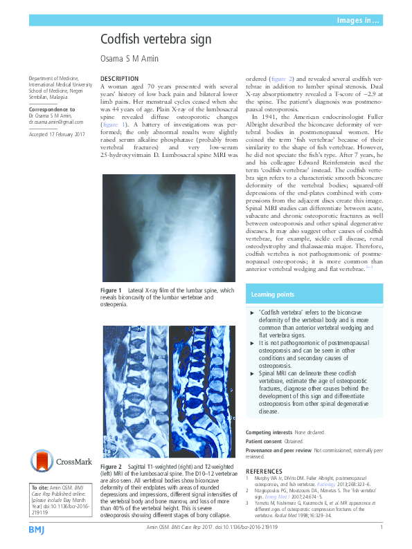 (PDF) Codfish vertebra sign