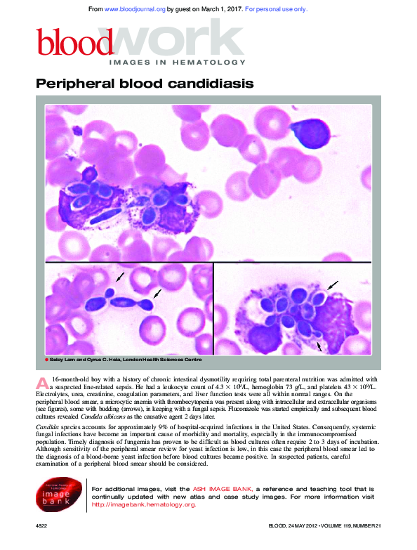 (PDF) Peripheral blood candidiasis | Cyrus Hsia - Academia.edu