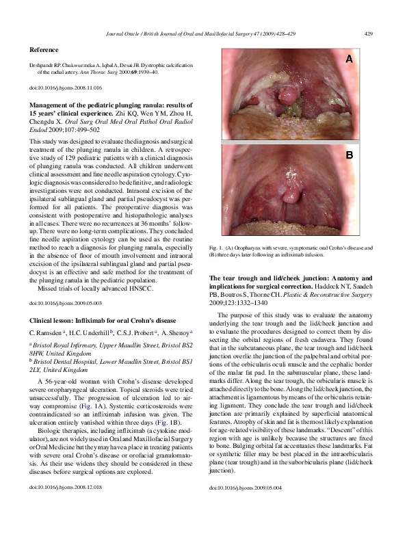 (PDF) The Tear Trough and Lid/Cheek Junction: Anatomy and Implications ...
