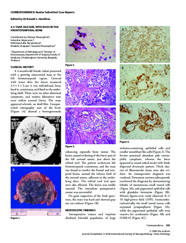 (PDF) A 4-YEAR-OLD Girl with Mass in the Frontotemporal Bone