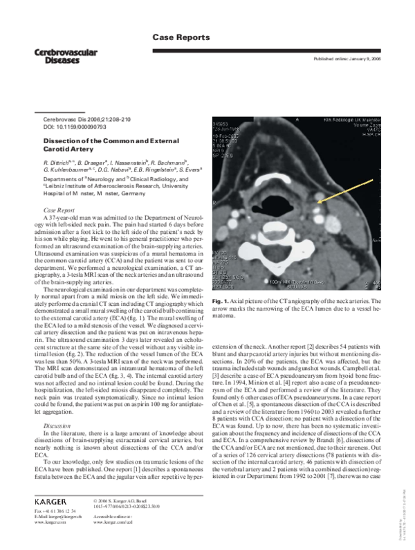 (PDF) Dissection of the Common and External Carotid Artery
