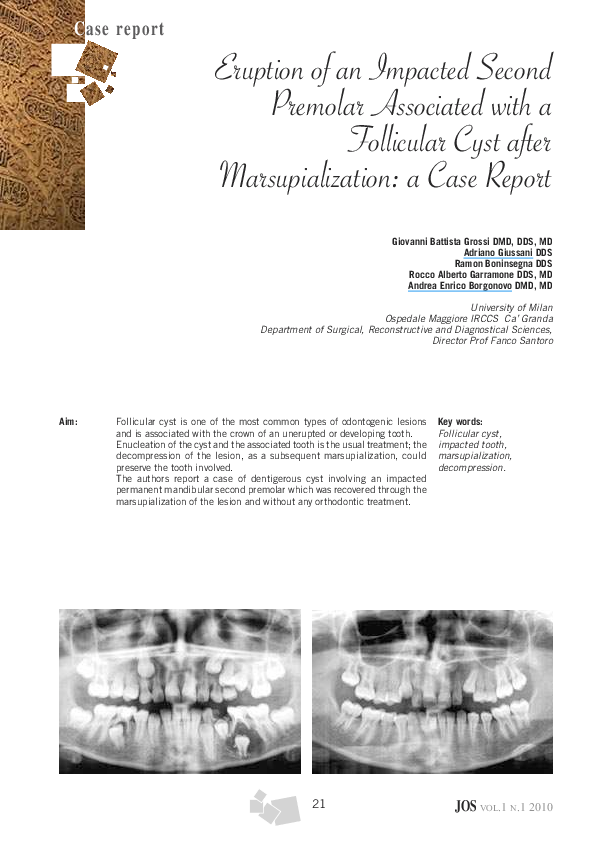 (PDF) Eruption of an Impacted Second Premolar Associated with a ...