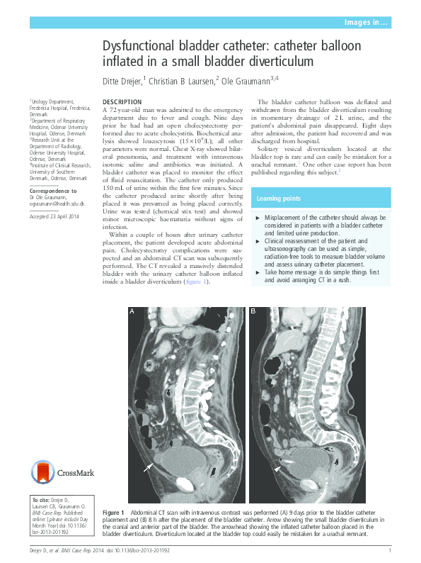 (PDF) Dysfunctional bladder catheter: catheter balloon inflated in a ...