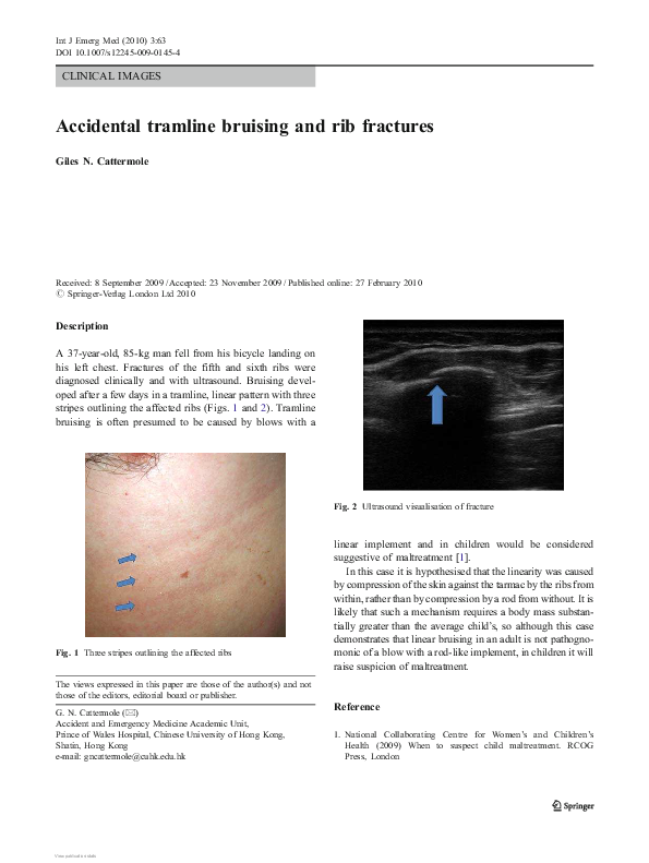 (PDF) Accidental tramline bruising and rib fractures