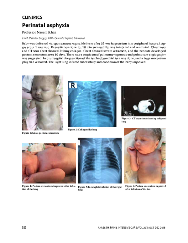 (PDF) Perinatal asphyxia