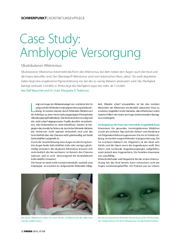 (PDF) Okulokutaner Albinismus.