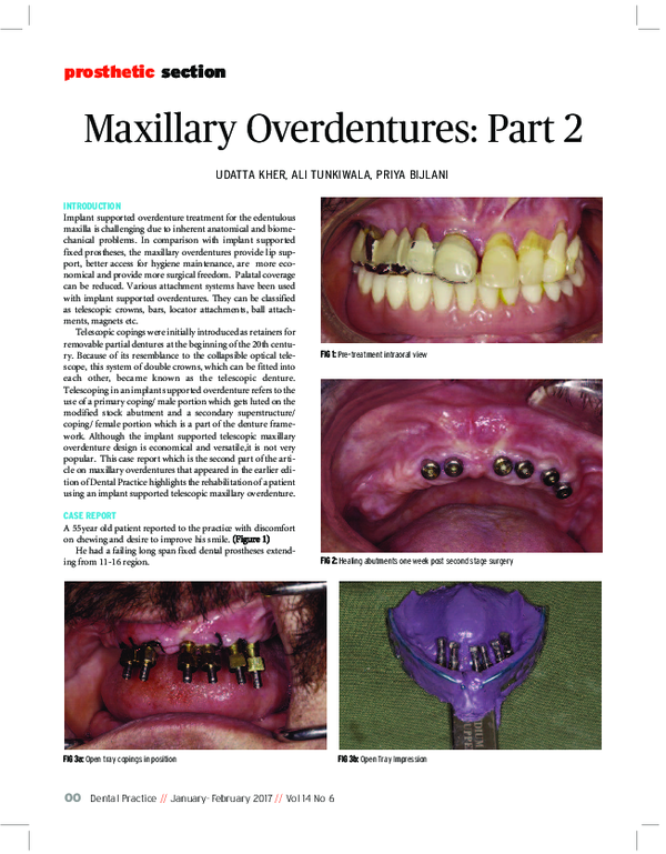 (PDF) Maxillary Overdentures Part