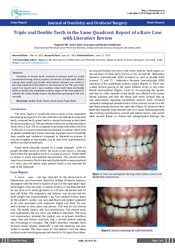 (PDF) Triple and Double Teeth in the Same Quadrant: Report of a Rare ...