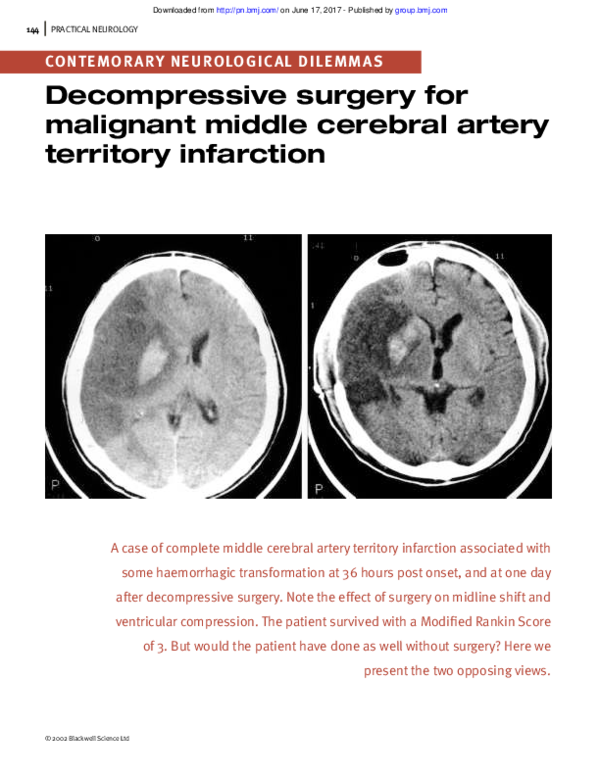 Malignant Cerebral Artery Syndrome