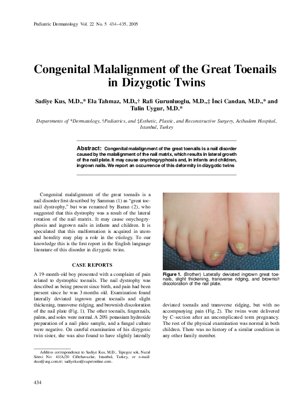 (PDF) Congenital Malalignment of the Great Toenails in Dizygotic Twins