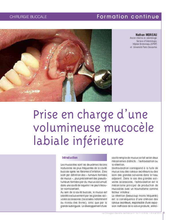 (PDF) Prise en charge d'une volumineuse mucocèle labiale inférieure