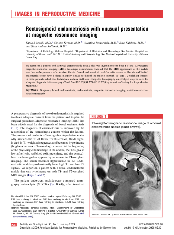(PDF) Rectosigmoid endometriosis with unusual presentation at magnetic ...