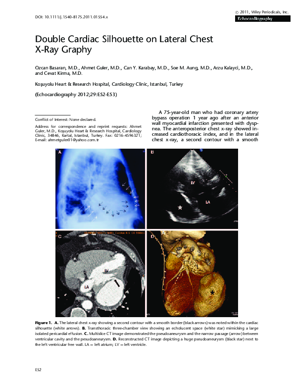 (PDF) Double Cardiac Silhouette on Lateral Chest X-Ray Graphy