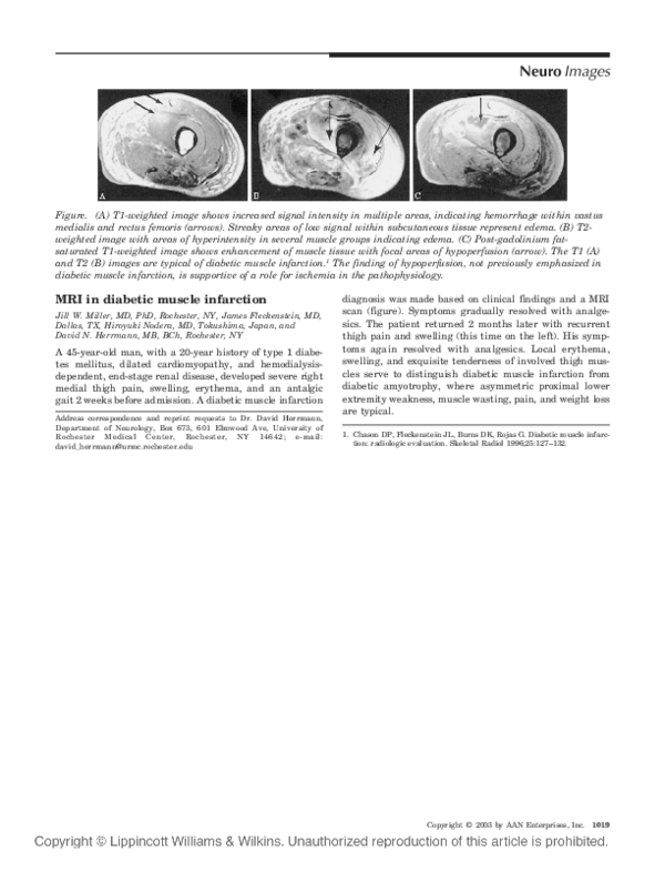 (PDF) MRI in diabetic muscle infarction