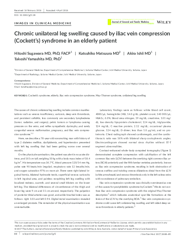 (PDF) Chronic unilateral leg swelling caused by iliac vein compression ...