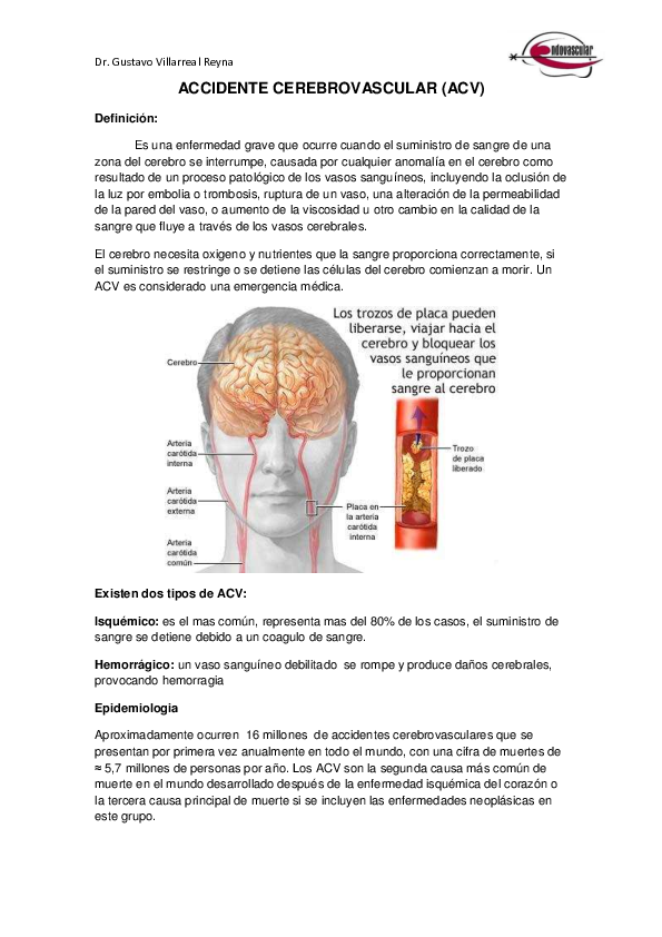 (PDF) ACCIDENTE CEREBROVASCULAR (ACV