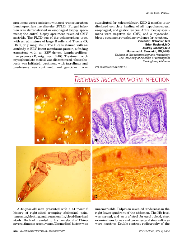 (PDF) Trichuris trichiura worm infection