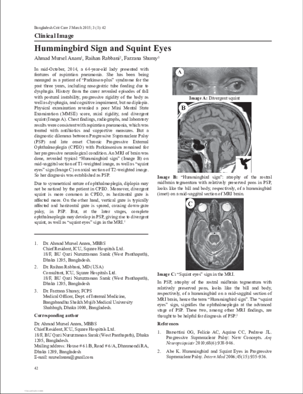 (PDF) Hummingbird Sign and Squint Eyes