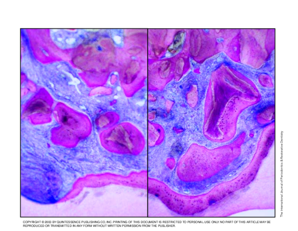 (PDF) Evaluation of periodontal regeneration following grafting ...