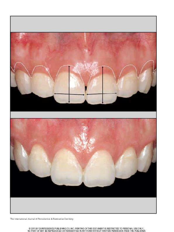 (PDF) Anatomical crown width/length ratios of worn and unworn maxillary ...