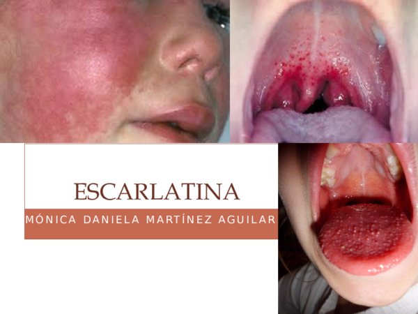 (PPT) Escarlatina