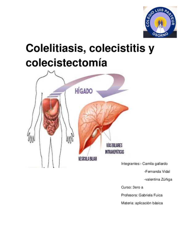 (DOC) Colelitiasis, colecistitis y colecistectomía