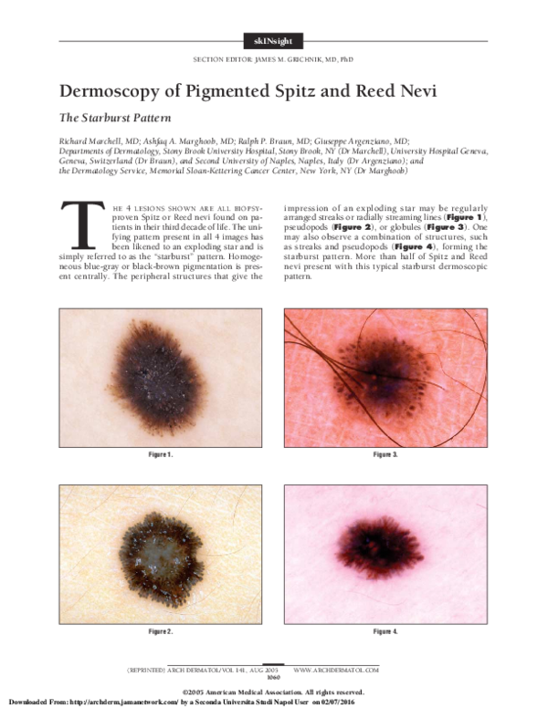 (PDF) Dermoscopy of Pigmented Spitz and Reed Nevi The Starburst Pattern