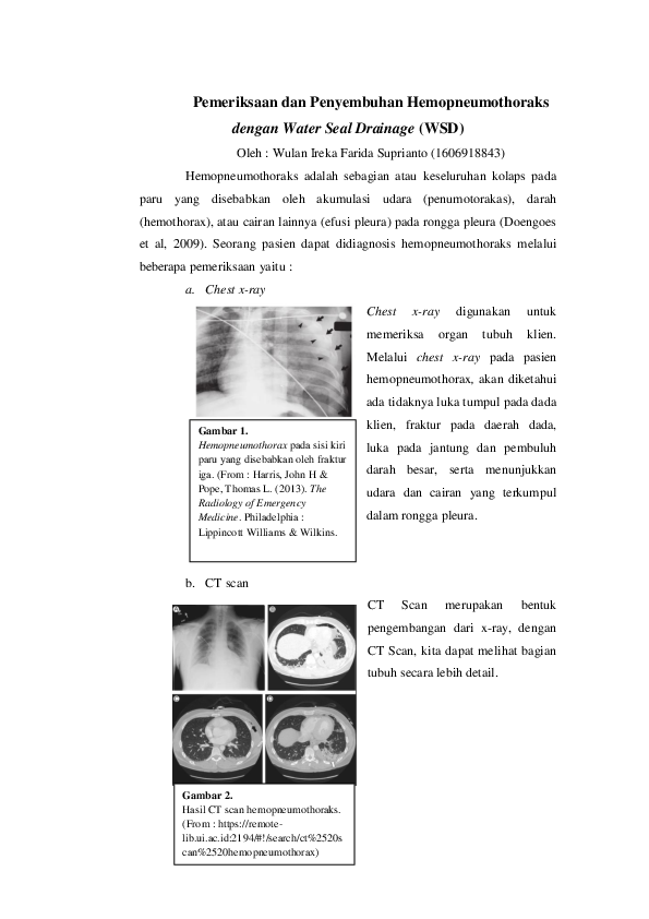 (DOC) Penyembuhan Hemopneumothoraks dengan Water Seal Drainage (WSD)