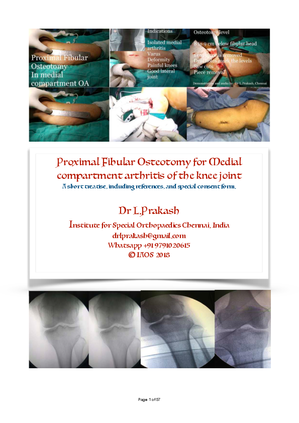 (PDF) Proximal Fibular Osteotomy for Medial compartment arthritis of ...