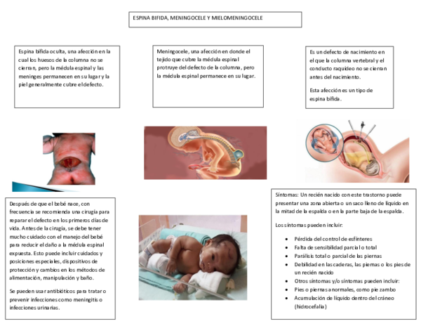 (DOC) MIELOMENINGOCELE