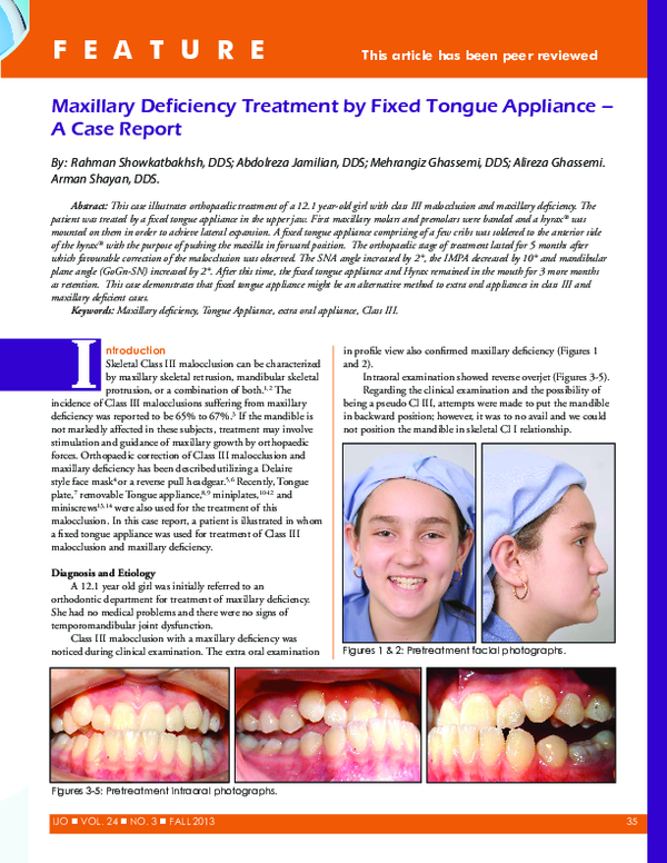 (PDF) Maxillary Deficiency Treatment by Fixed Tongue Appliance – A Case ...