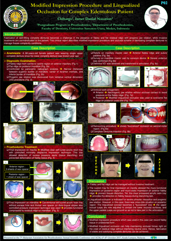 (PDF) Modified Impression Procedure and Lingualized Occlusion for ...