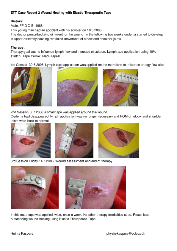 (PDF) ETT Case Report Casus 2 in English