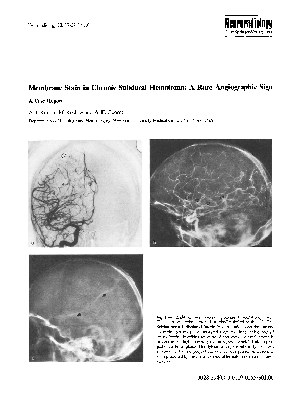 (PDF) Membrane stain in chronic subdural hematoma: a rare angiographic ...