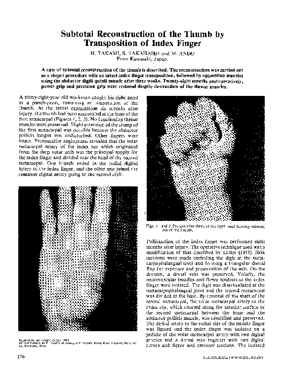 (PDF) Subtotal reconstruction of the thumb by transposition of index finger
